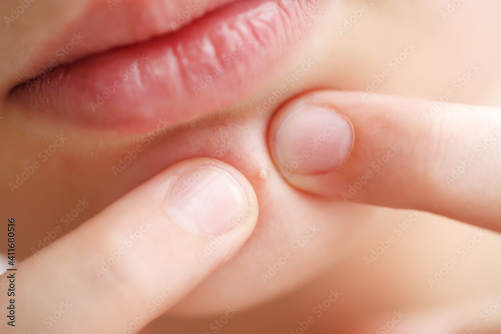 Teenage acne on the chin. Close up face with pimple. Teen problem. High ...