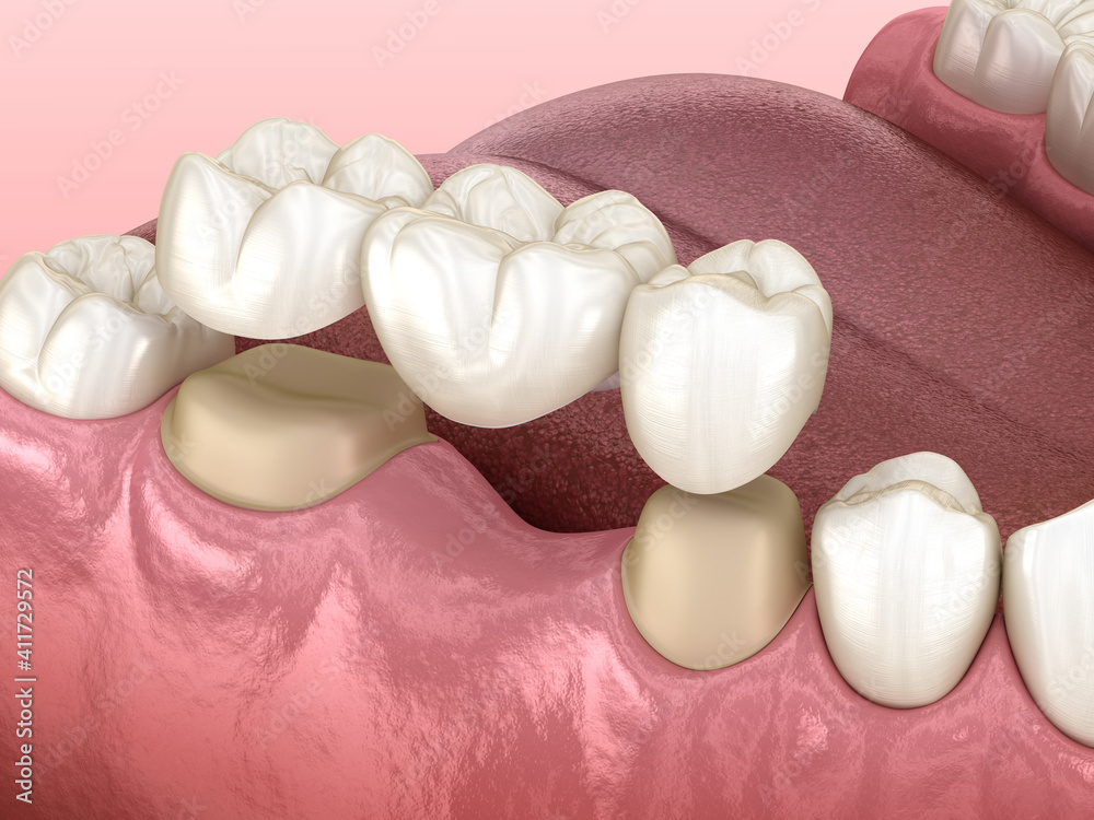 Dental bridge of 3 teeth over molar and premolar. Medically accurate 3D ...