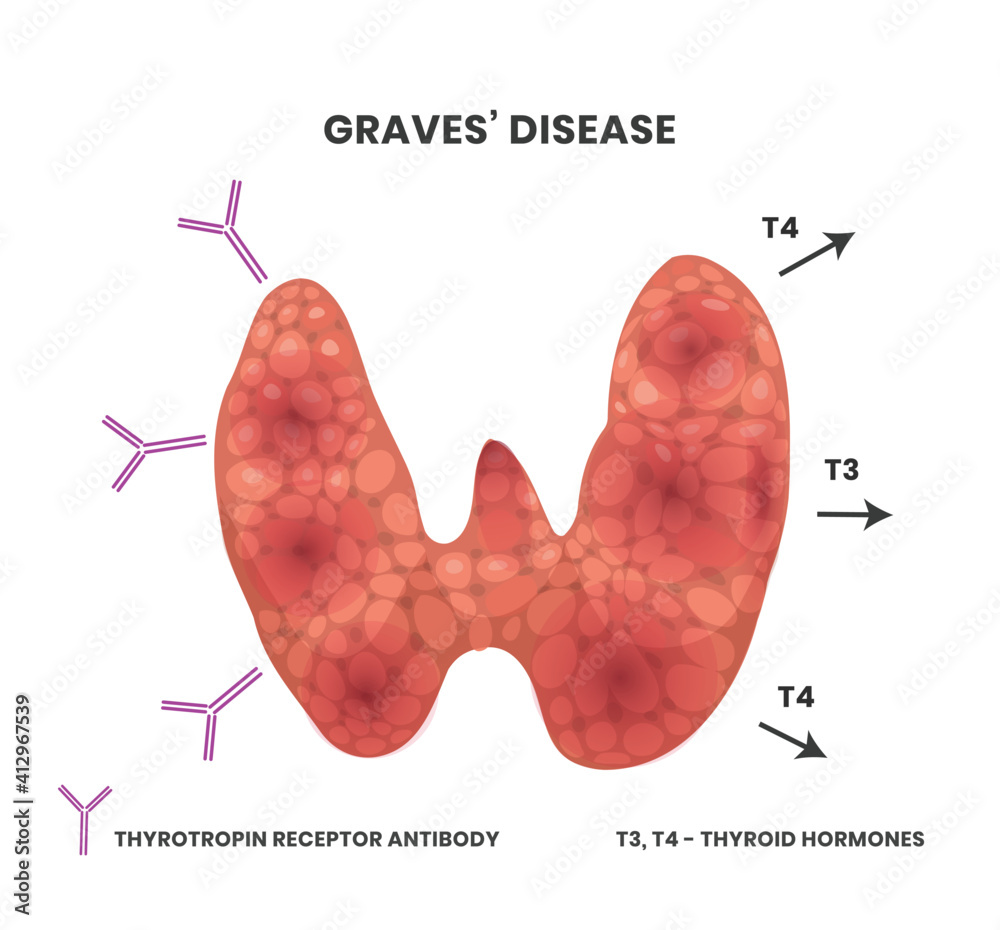 Illustration of the Graves disease causes. Vector scheme showing ...