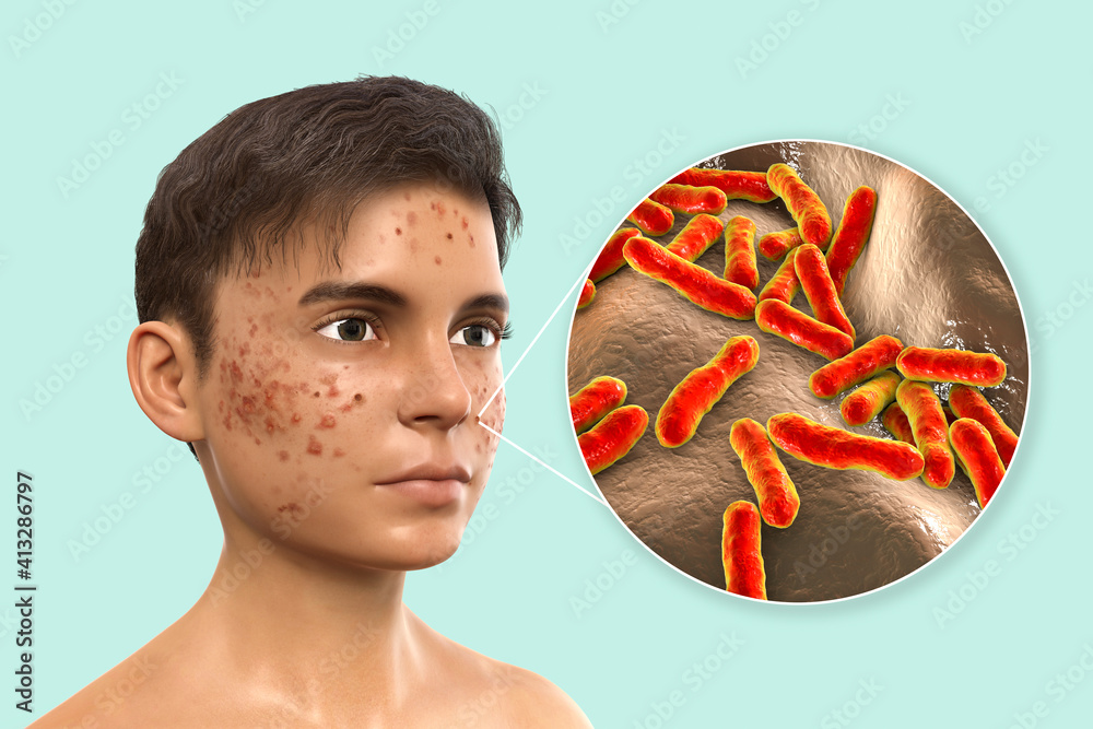 Acne vulgaris and bacteria Cutibacterium acnes Stock Illustration ...