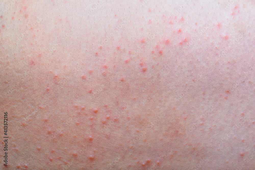 Skin allergy problem macro closeup as a background. Many little red ...