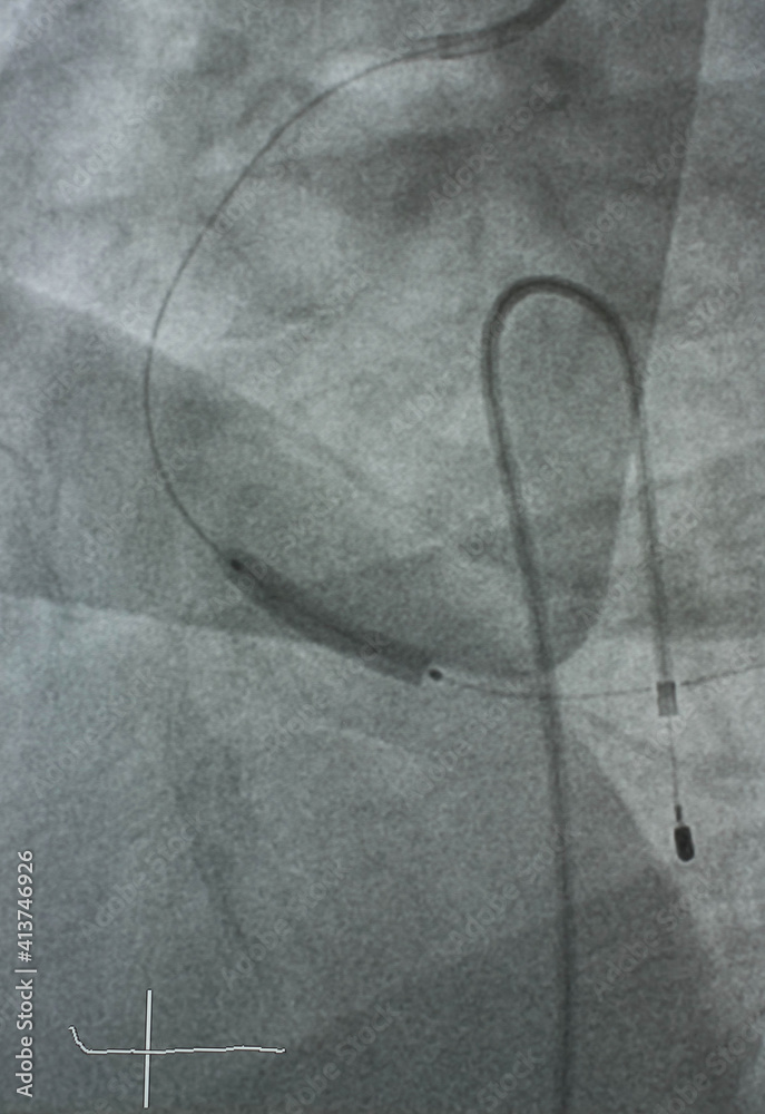 Coronary angiogram , medical x-ray for heart disease. Coronary artery ...