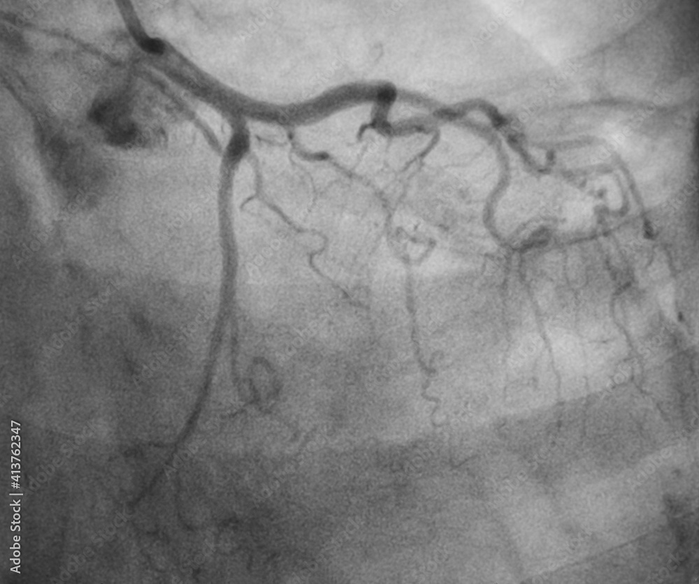 Coronary angiogram , medical x-ray for heart disease. Coronary artery ...