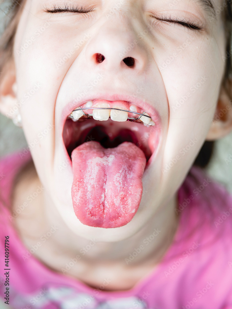 The Doctor Examines The Child S Throat Little Girl Opened Her Mouth