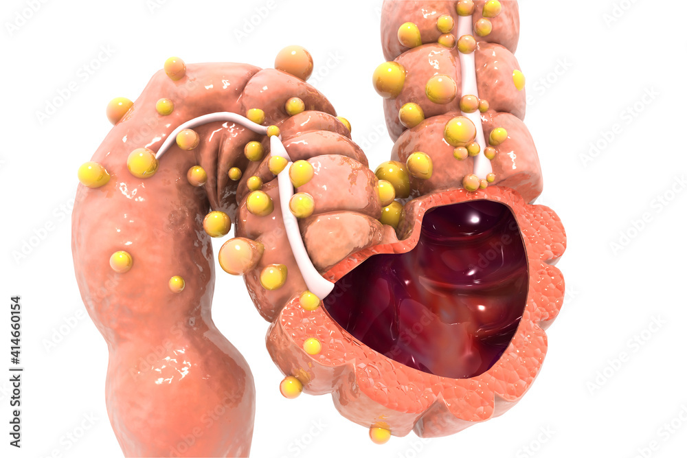 Human colon, Colon anatomy, cross section, colon disease, scientific ...