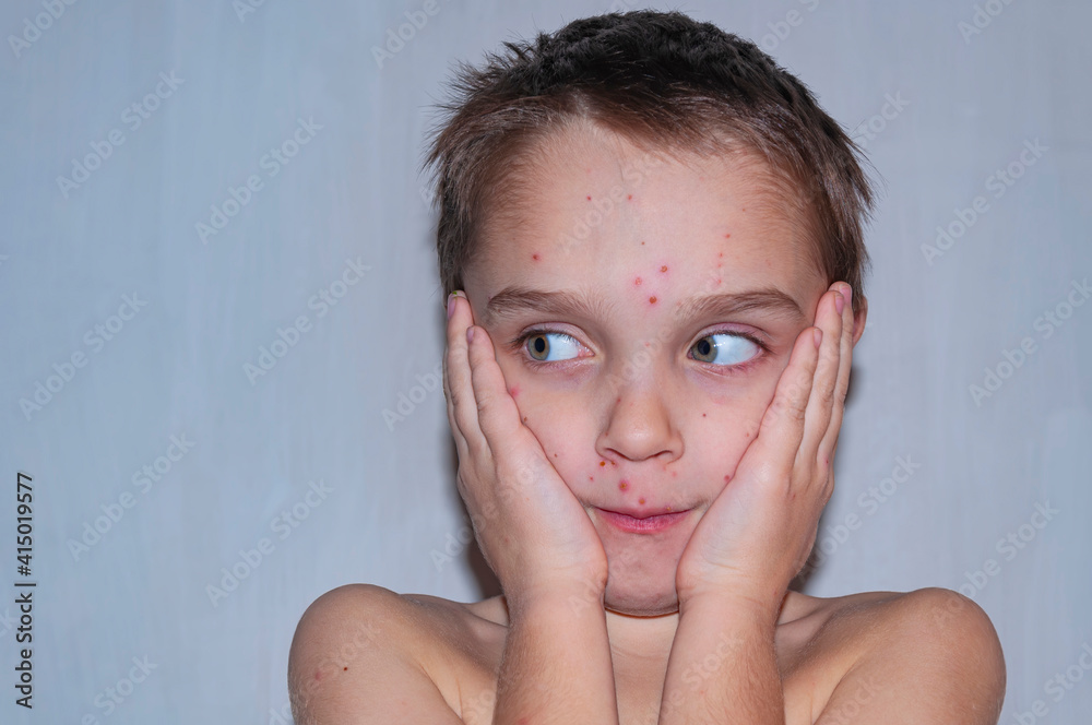 Chickenpox disease, with fever and runny nose. Boy sick on his face ...