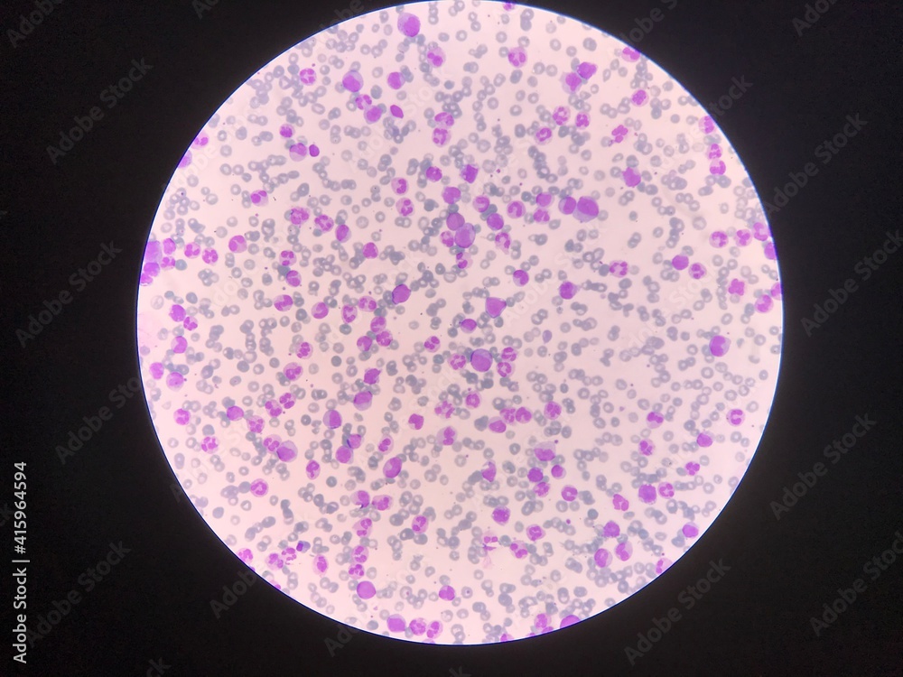 Foto Immature and mature white blood cells.Segmented neutrophil,blast ...