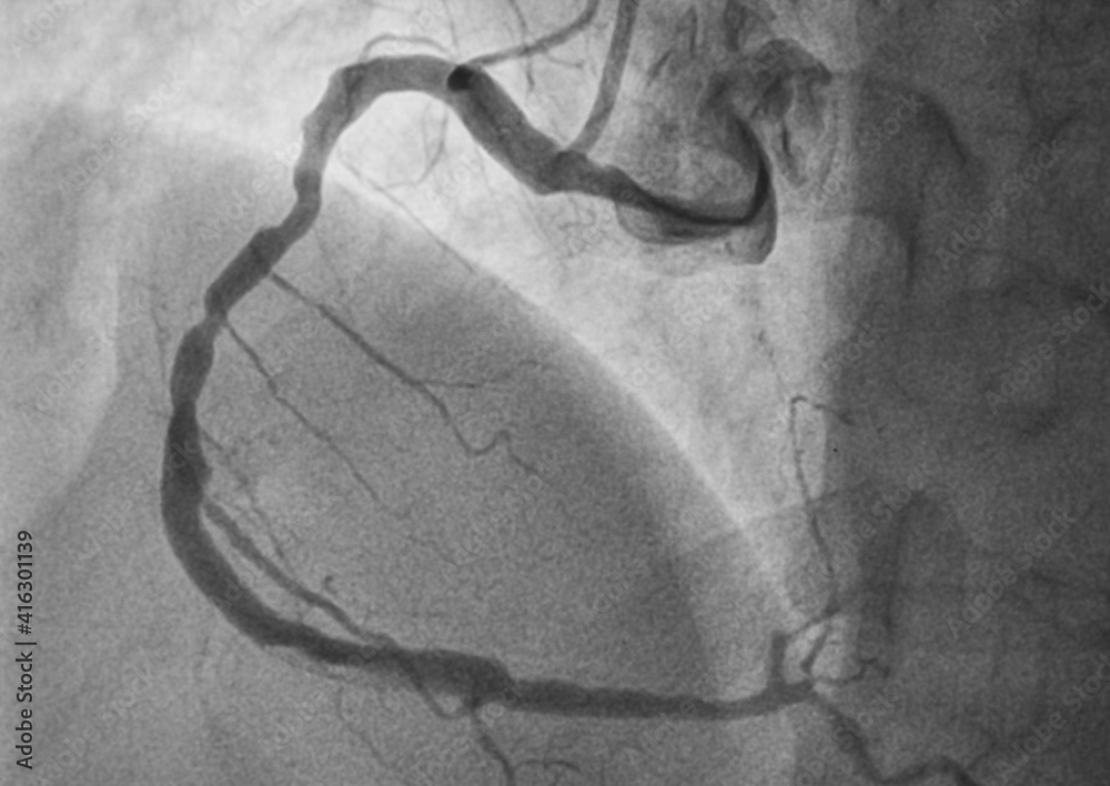 Coronary angiogram , medical x-ray for heart disease. Coronary artery ...