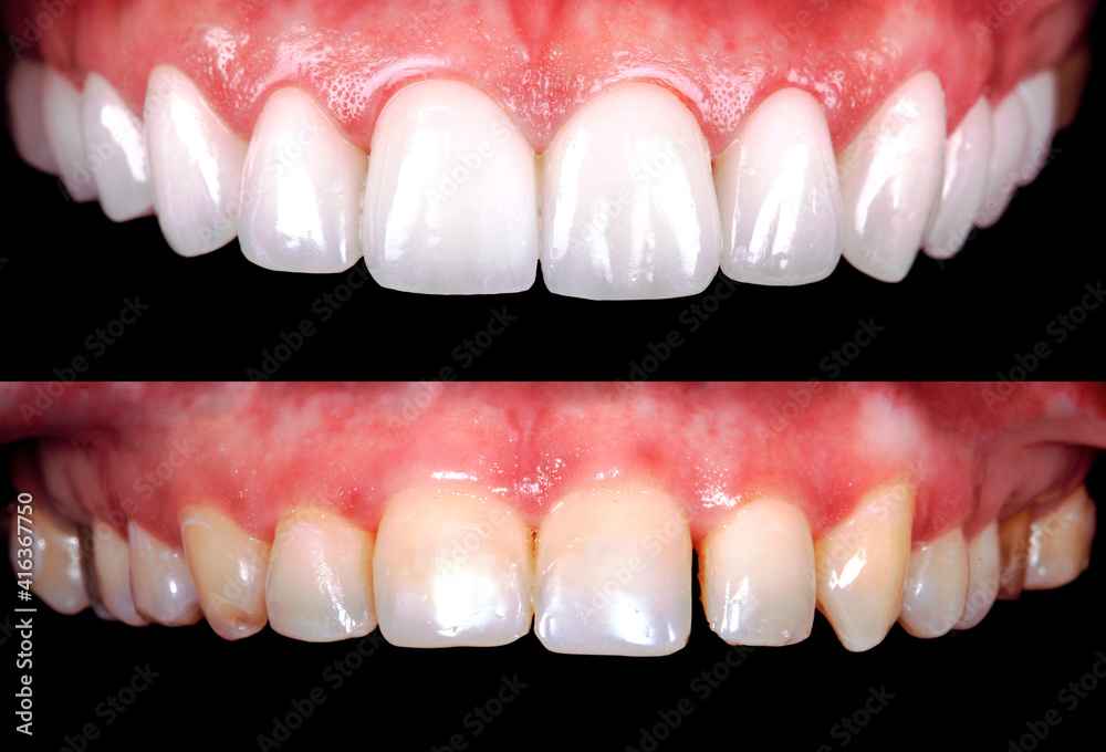 Perfect smile before and after bleaching procedure whitening of zircon ...