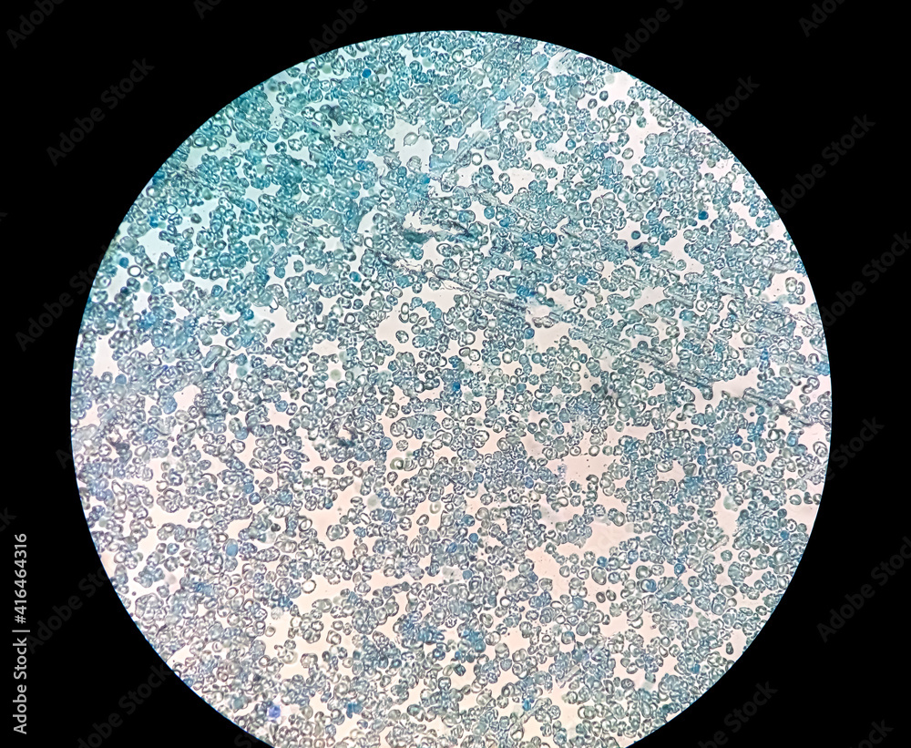 Reticulocyte count from blood smear (methylene blue staining ...