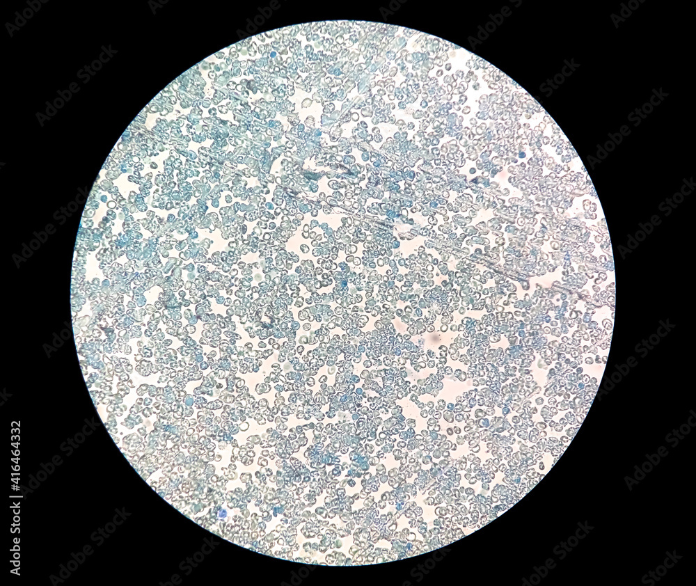 Reticulocyte count from blood smear (methylene blue staining ...