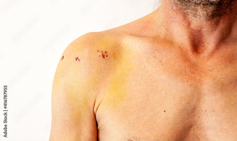 Male shoulder with scars after shoulder Arthroscope surgery. Chronic ...