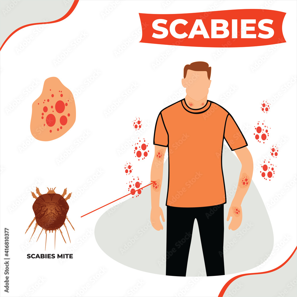 Scabies Patient with symptoms and mites vector Stock Vector | Adobe Stock