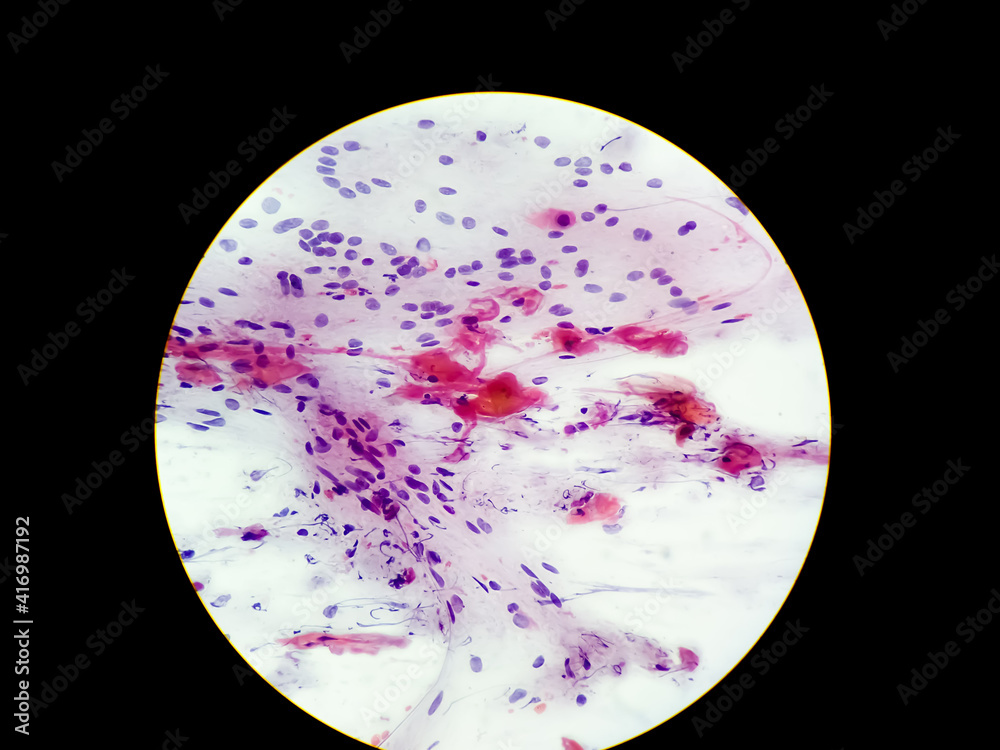 Normal endocervical cells and squamous epithelial cells of cervical ...