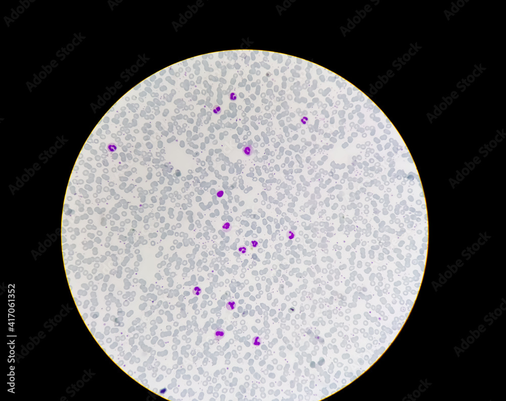Thrombocytosis microscopic view.Eessential thrombocytosis blood smear ...