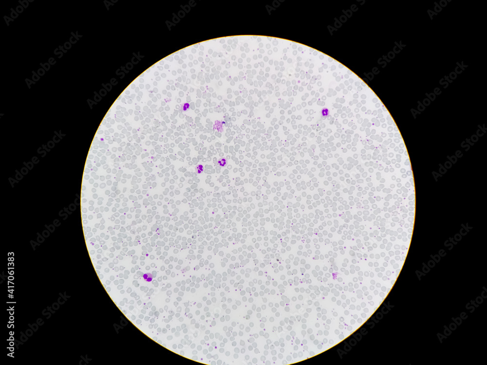 Thrombocytosis microscopic view.Eessential thrombocytosis blood smear ...