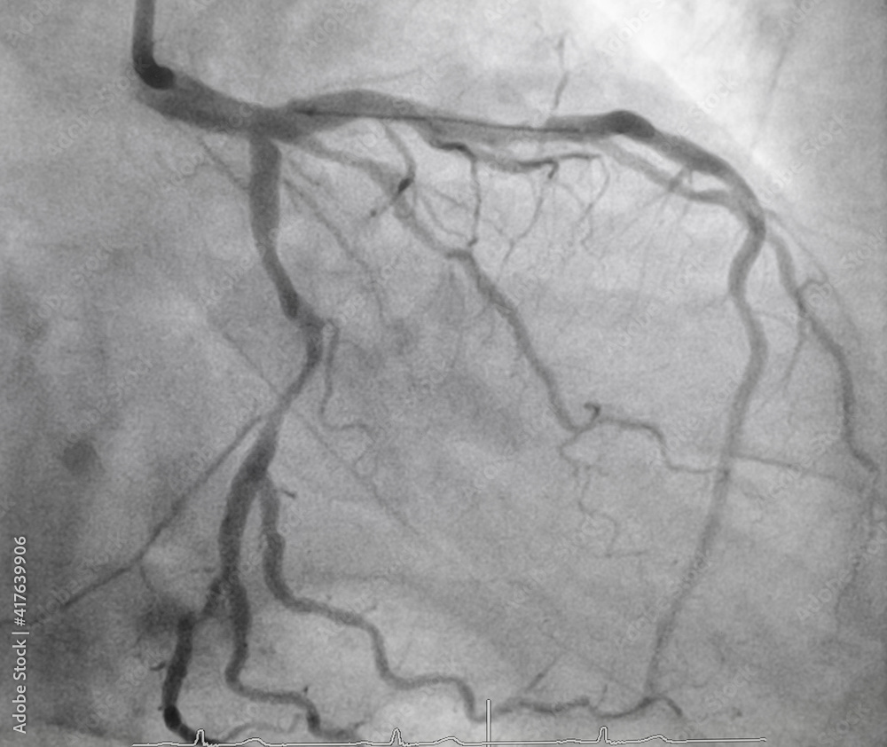 Coronary angiogram , medical x-ray for heart disease. Coronary artery ...