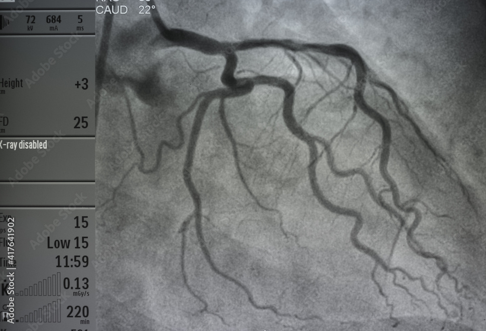 Coronary angiogram , medical x-ray for heart disease. Coronary artery ...