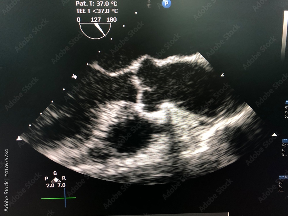 Transesophageal echocardiogram (TEE) shown Aortic valve (AV) closing in ...
