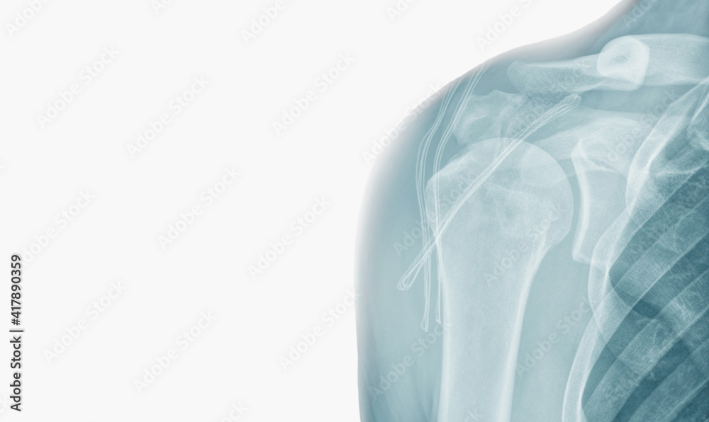 Foto Xray image of shoulder isolated. hanging bicep muscle. Chronic ...