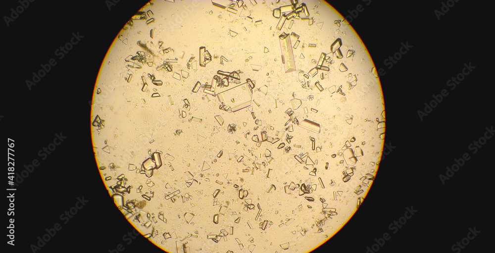 Crystallized urine sample due to kidney disease seen under the light ...