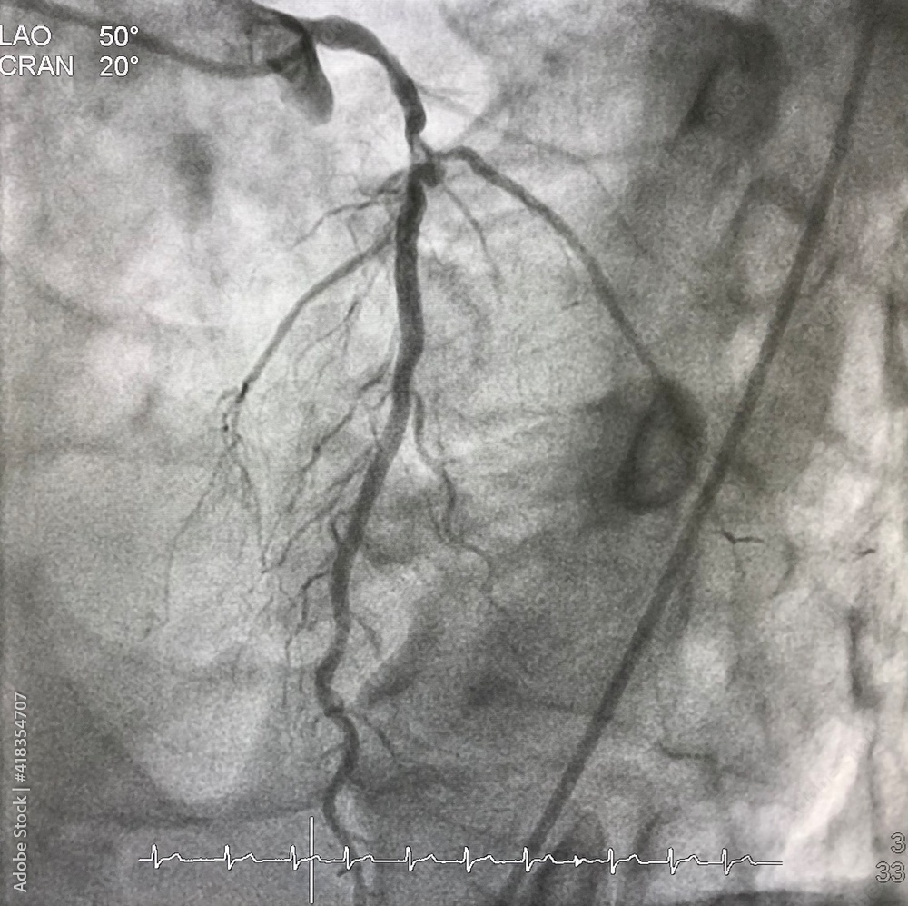 Coronary angiogram shown left anterior descending artery (LAD) stenosis ...