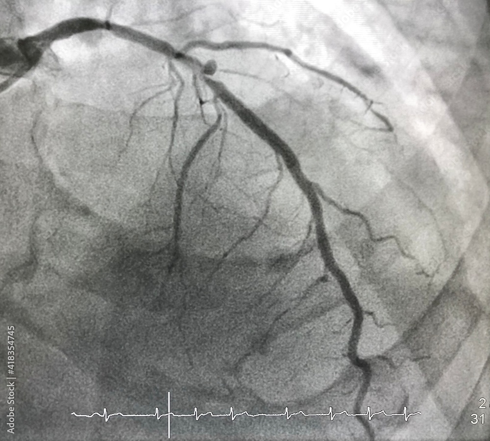 Coronary angiogram shown left anterior descending artery (LAD) stenosis ...