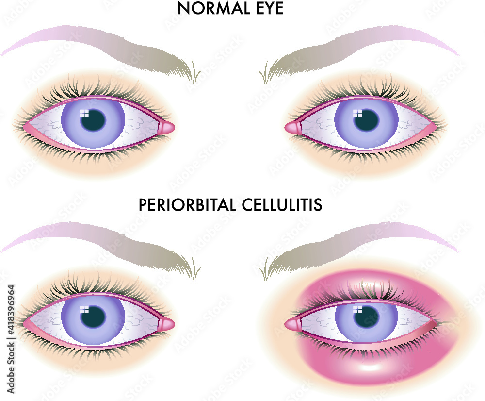 Medical illustration shows the comparison between normal eyes and those ...