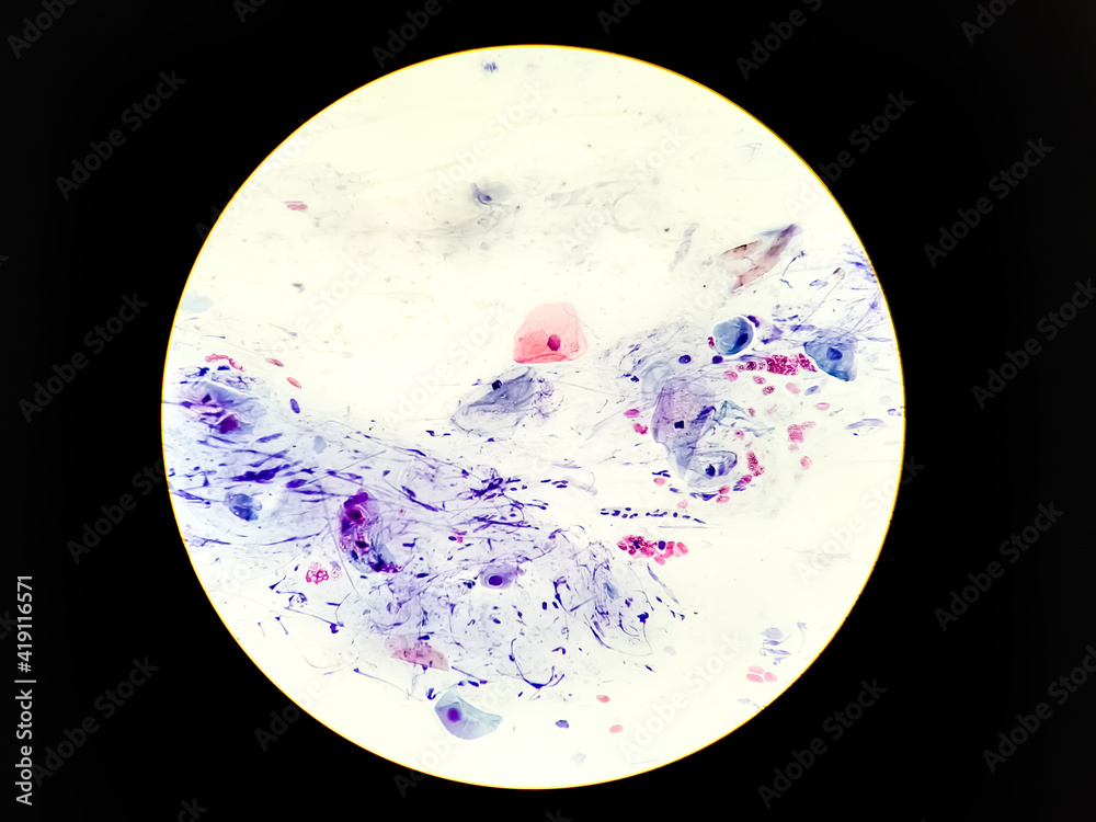 Abnormal squamous epithelial cells view in microscopy.HPV criteria for ...