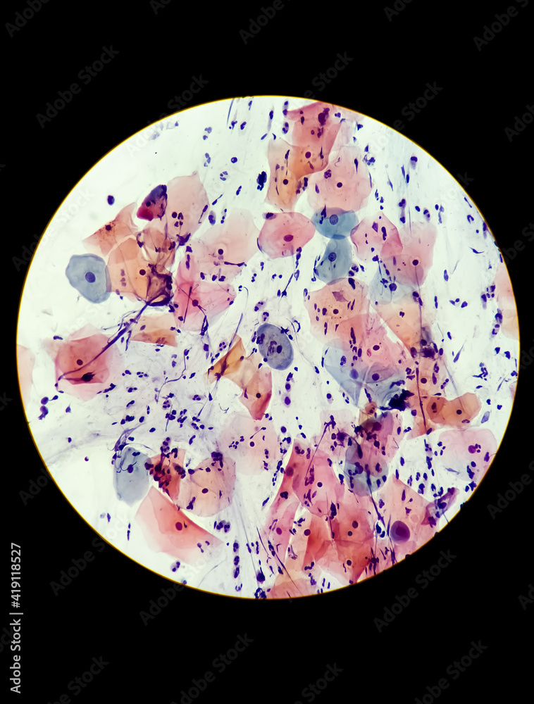 Normal squamous epithelial cells of cervical human view in microscopy ...