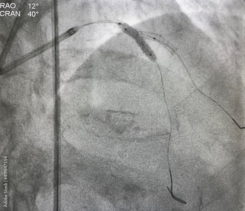 Two non-compliance balloons (NC balloon) inflated after coronary stent ...