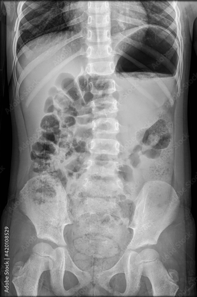intestinal obstruction in a child x ray, Film X-ray body of child ...