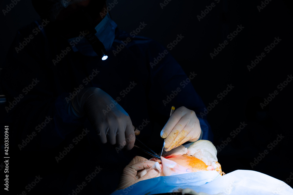 Face lifting close-up.. Macs lift surgery Minimal Access Cranial ...