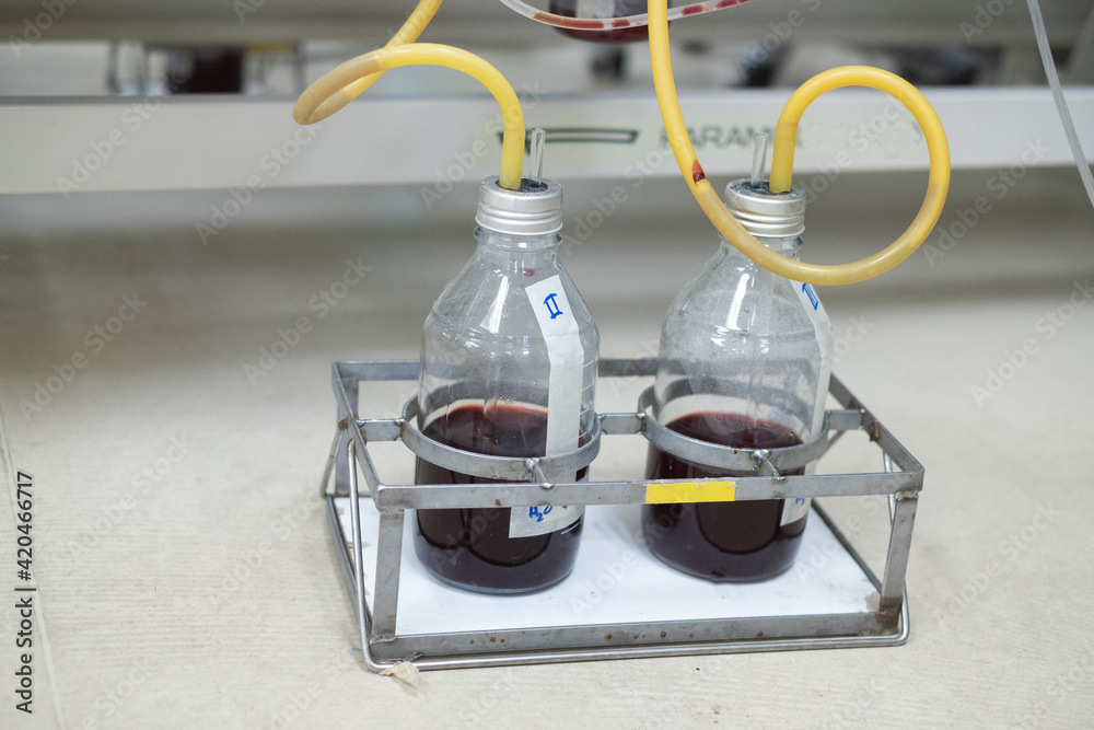Two bottle system of chest drainage for patient post open heart surgery ...
