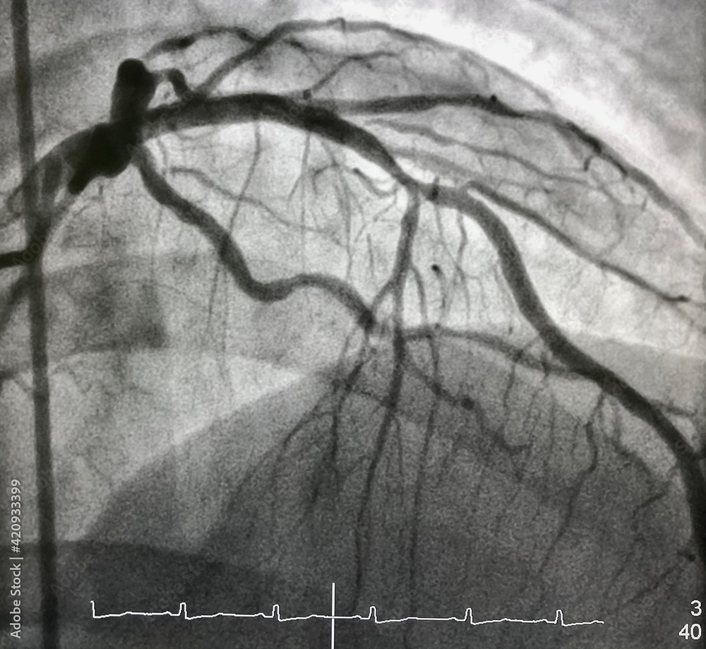 Coronary angiogram shown left anterior descending artery (LAD) stenosis ...