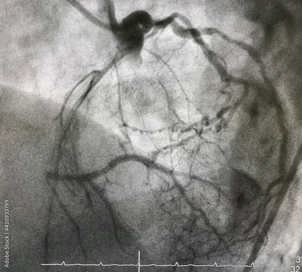 coronary angiogram showed chronic total occlusion (CTO) of left ...