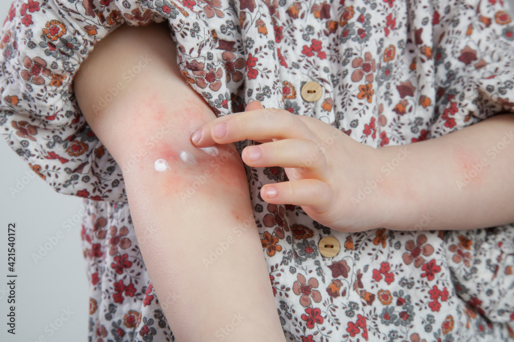Toddler girl suffering from atopic dermatitis, close up image. Red and itchy skin. Eczema on kid ...