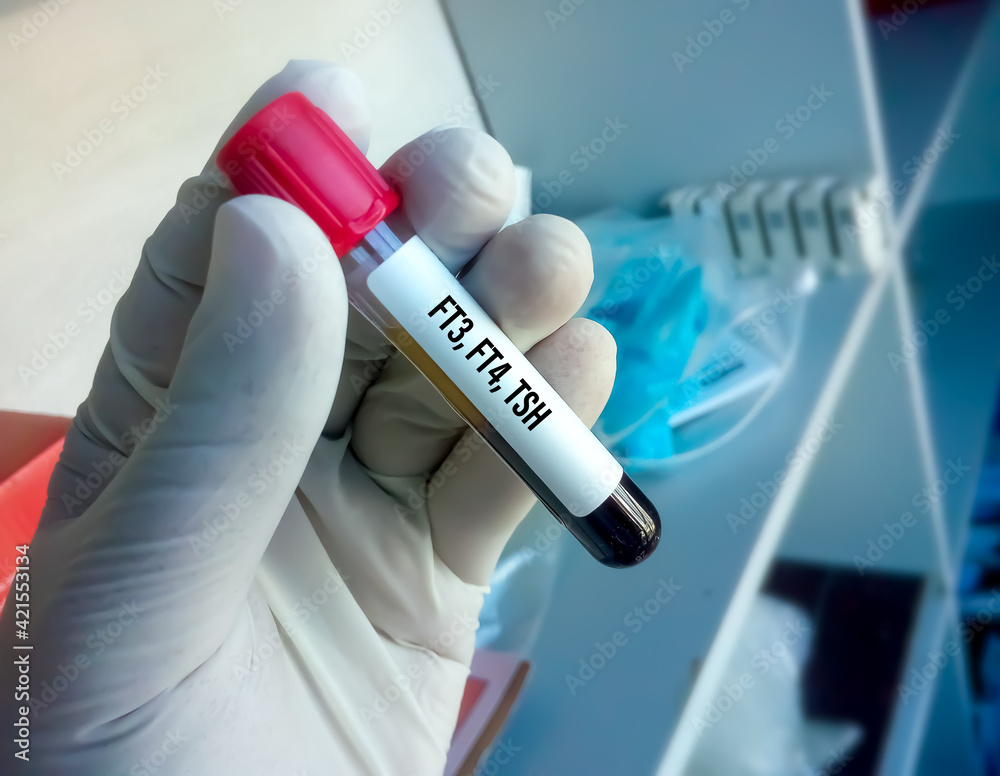 Blood sample in test tubes for hormonal examination of thyroid gland in ...
