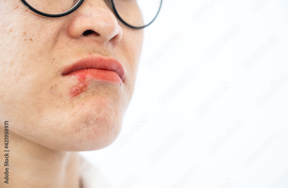 Herpes labialis of the woman lower lip with isolated copy space ...
