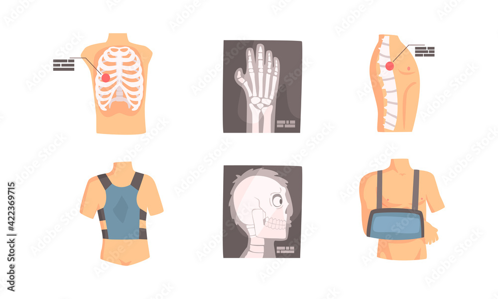 Bone Fractures Set, Medical Examination and Treatment of Back and Spine ...