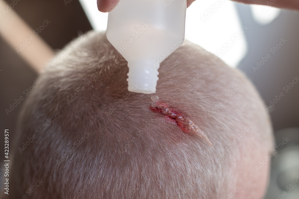 Injury to the scalp. Blood leaks from a chopped wound on the head. The ...