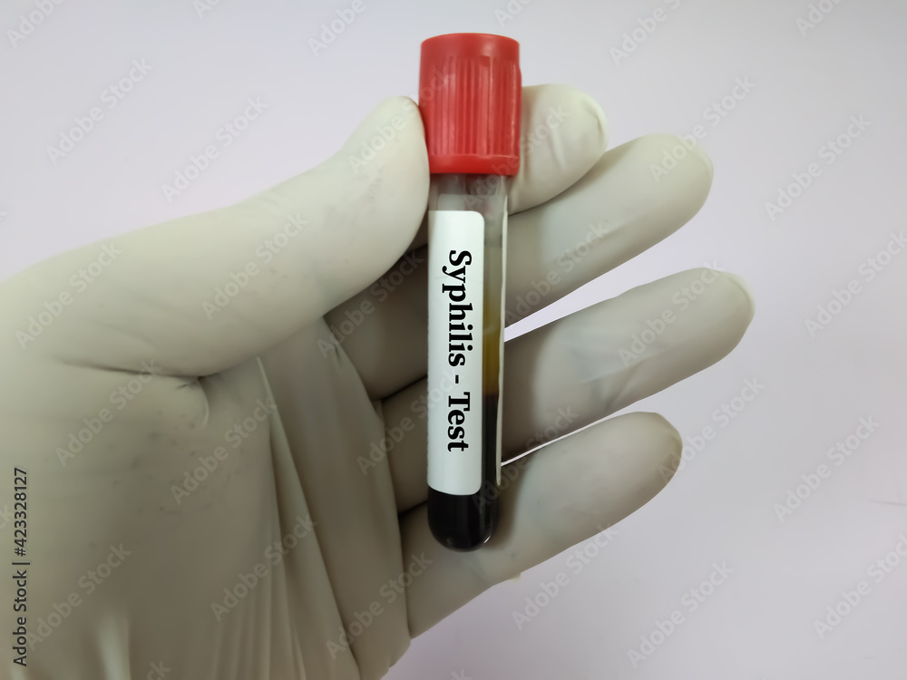 Stock-Foto „Test Tube with blood sample for syphilis test, sexually ...