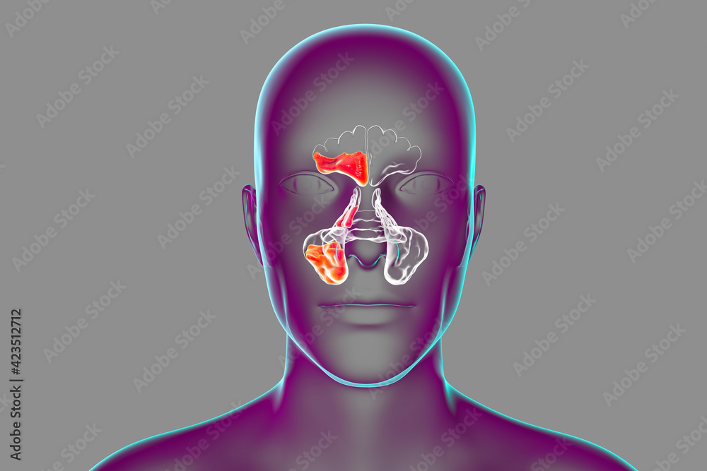 Sinusitis, inflammation of right frontal and maxillary sinuses 素材庫插圖 ...