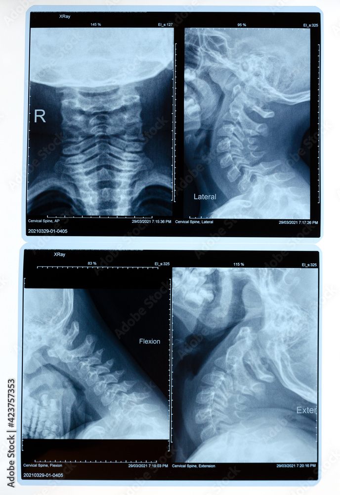 Fluorography. a snapshot of the x-ray of the cervical spine in four ...