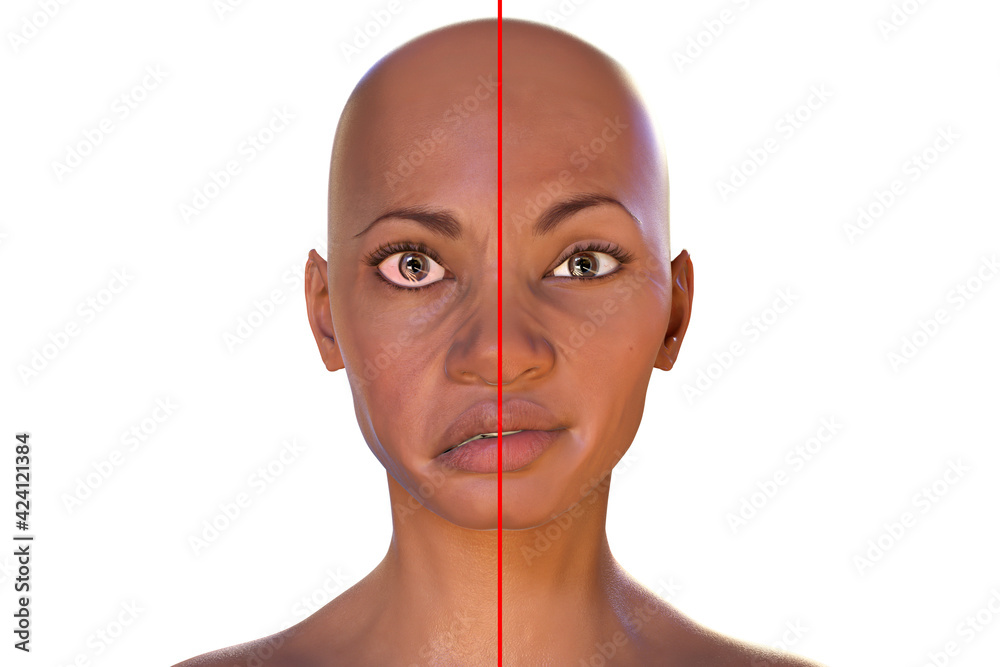 Facial nerve paralysis, Bell's palsy, illustration showing female with ...