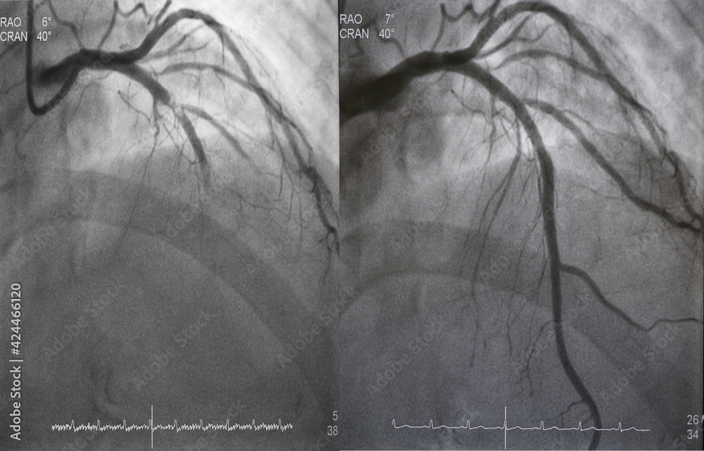 Comparison of pre-post percutaneous coronary intervention (PCI) at ...