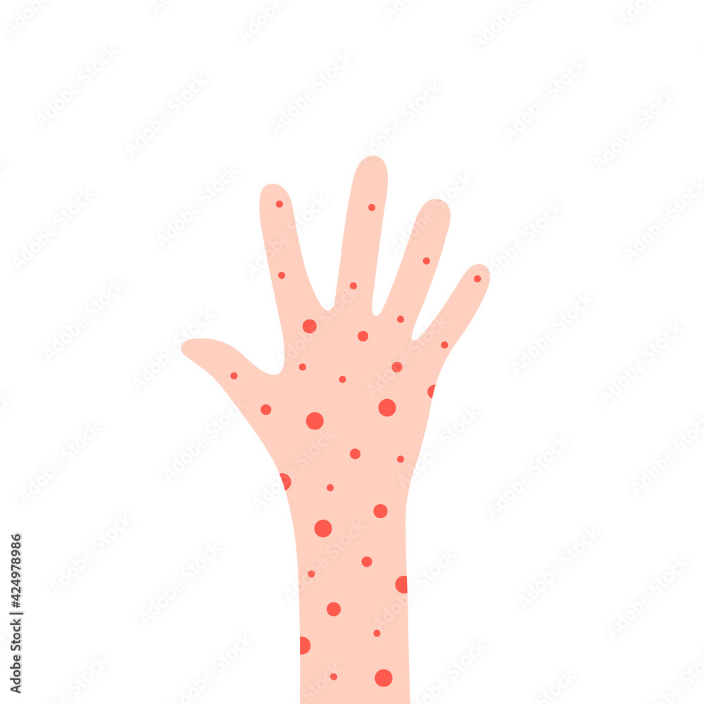 cartoon hand with rash like allergy Stock Vector | Adobe Stock