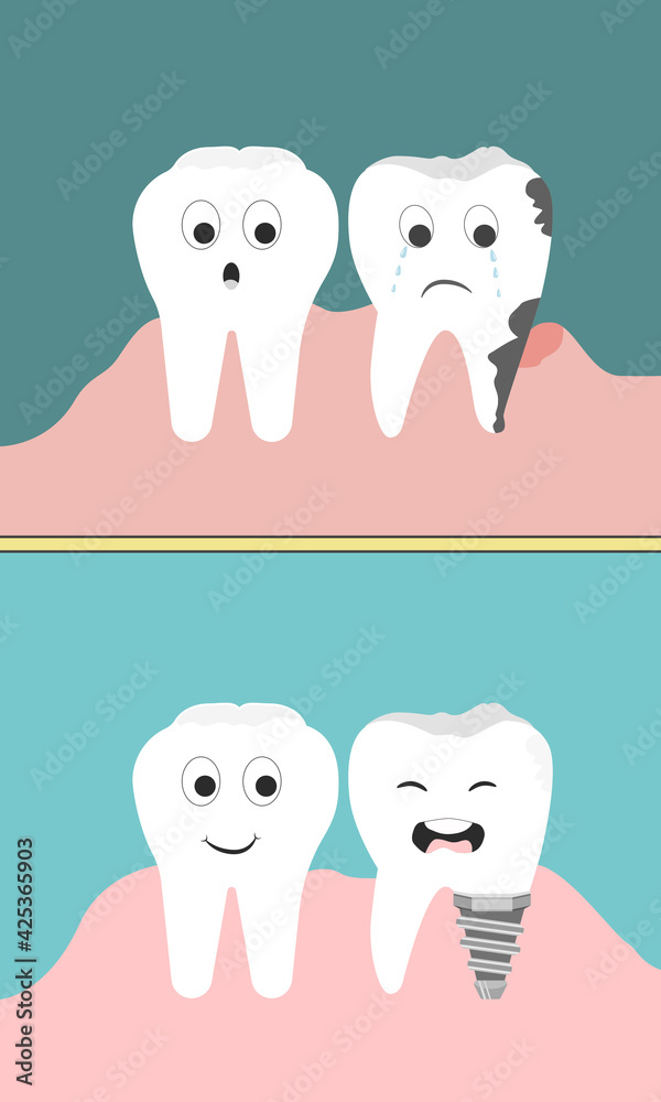 teeth happy & teeth sad.Dental implant structure medical pictorial ...