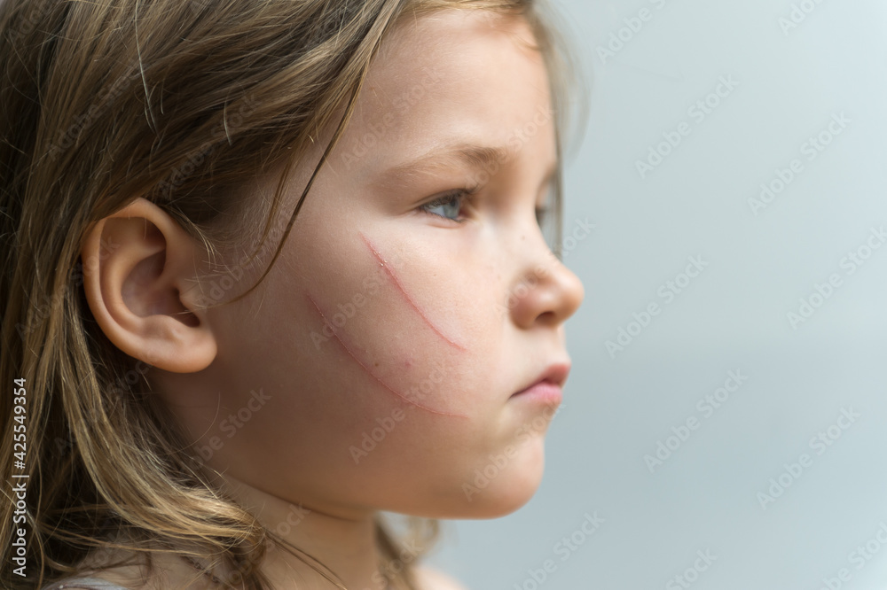 Sad little kid girl with long big scratches from cat on her face ...