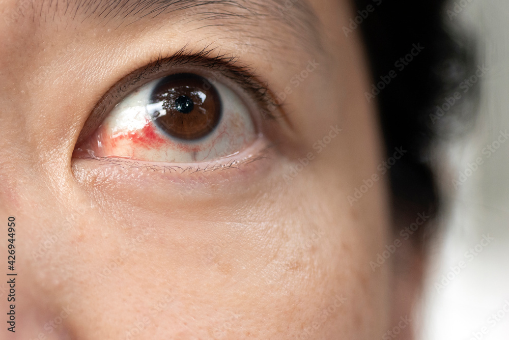 Foto de Stock Broken blood vessels, Subconjunctival Hemorrhage, Broken ...